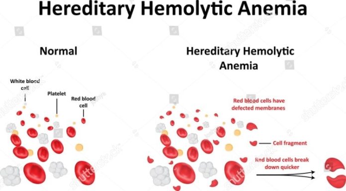 The Many Types of Hemolytic Anemia You must Know About - Trionds